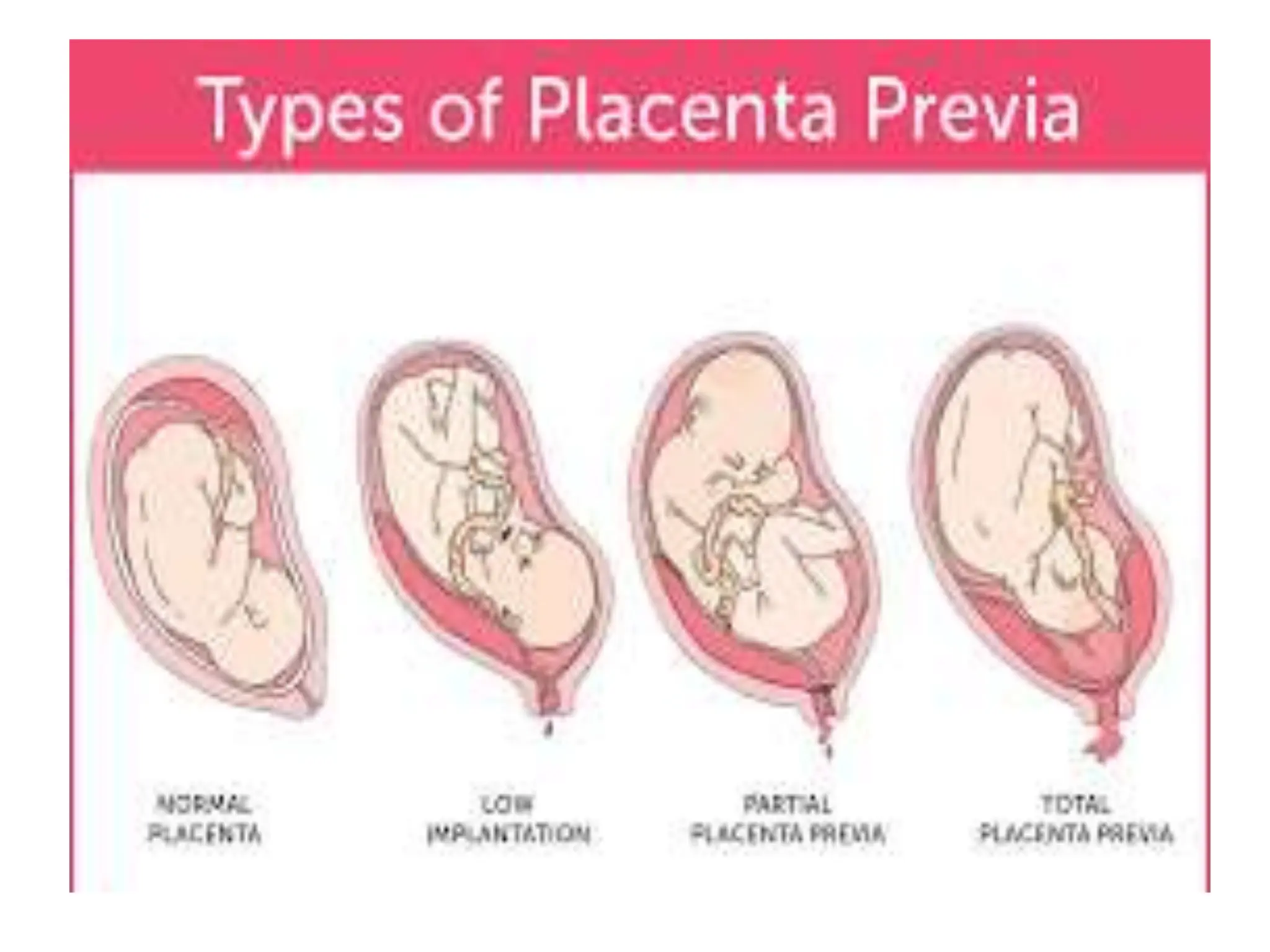 placenta ppt.pptx OBSTETRICS and gynaecologist | PPTX