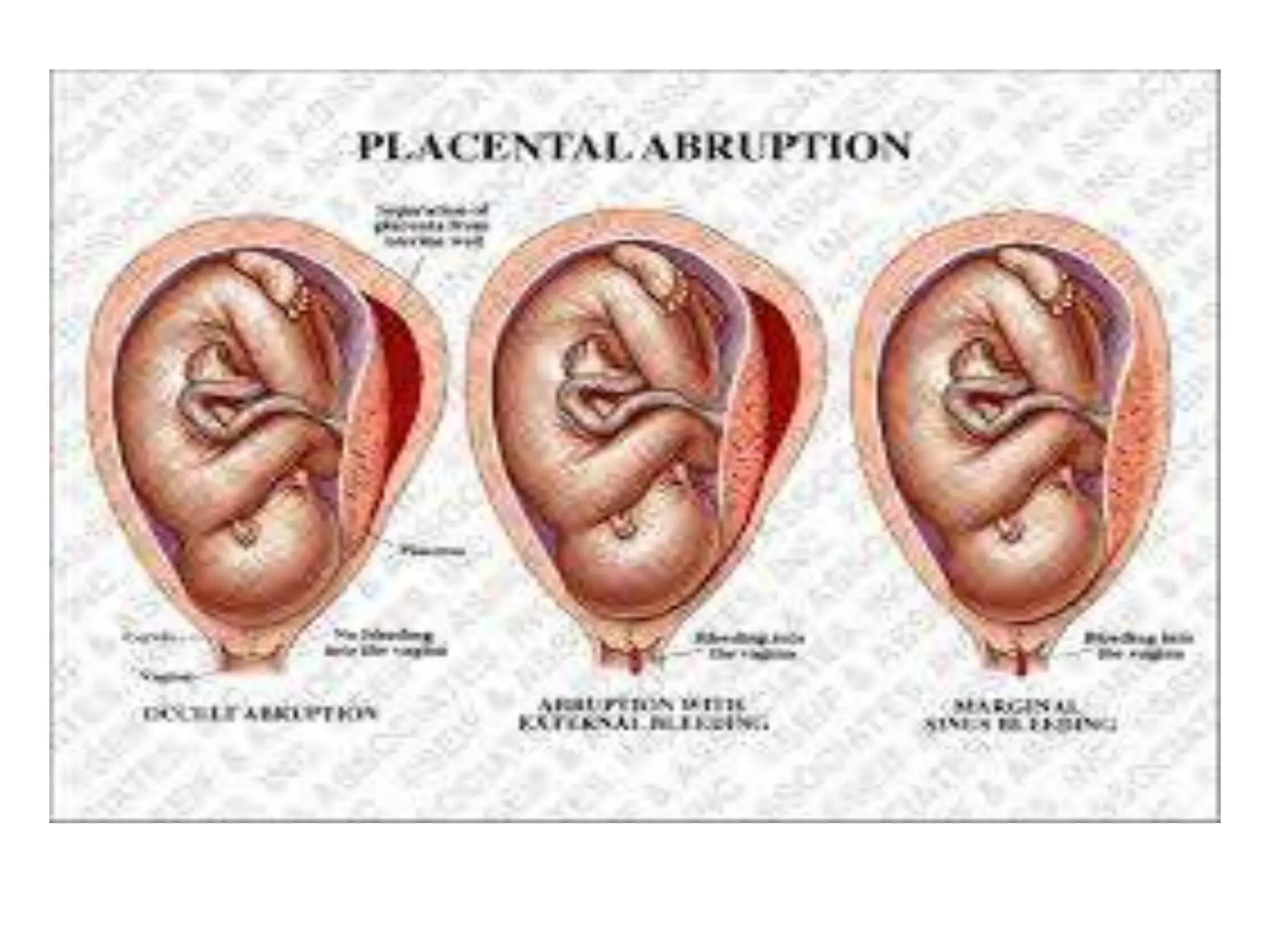placenta ppt.pptx OBSTETRICS and gynaecologist | PPTX