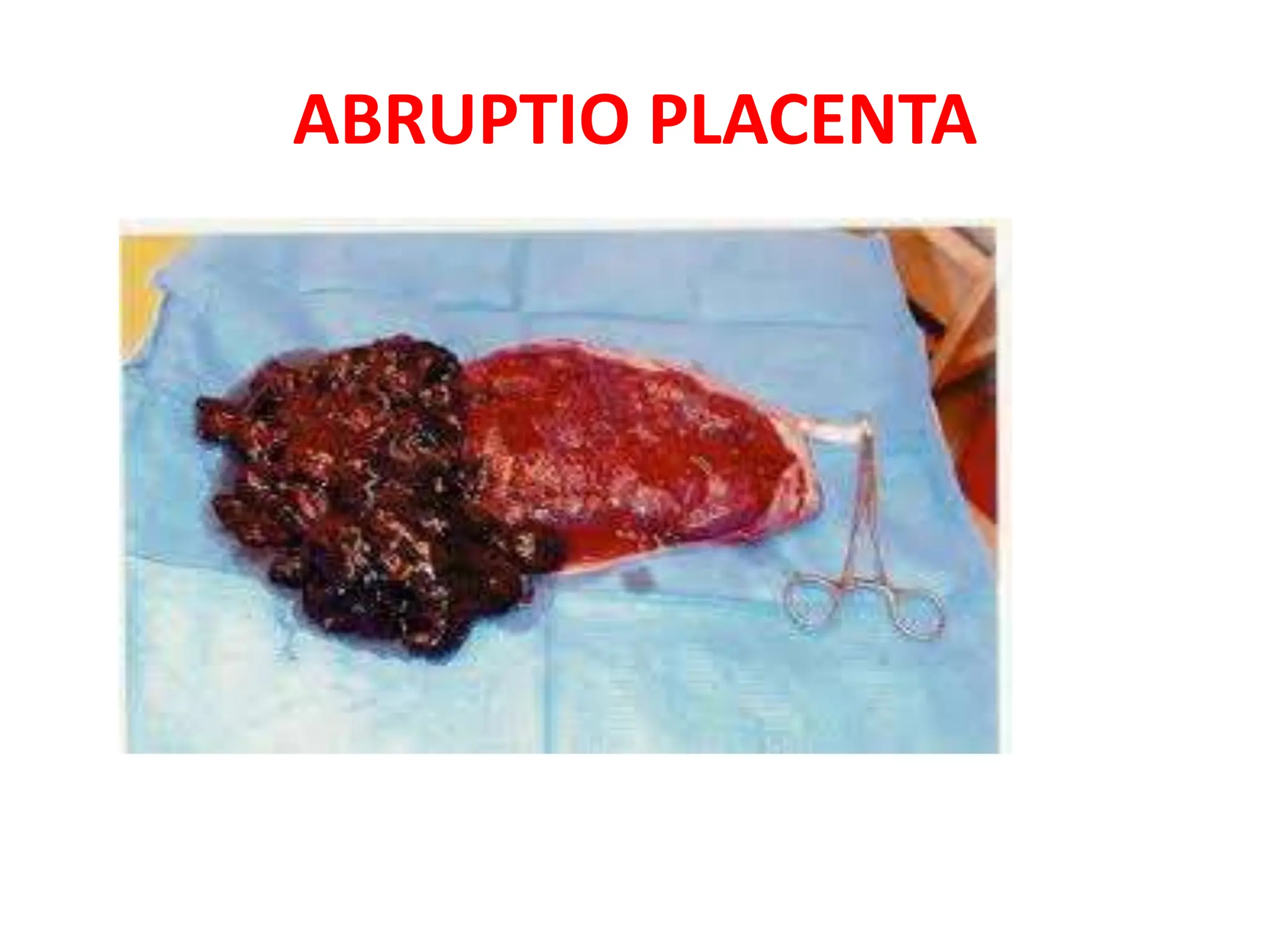 placenta ppt.pptx OBSTETRICS and gynaecologist | PPTX