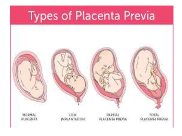 placenta ppt.pptx OBSTETRICS and gynaecologist | PPT