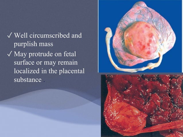 placenta grossing and it’s pathologies .pdf