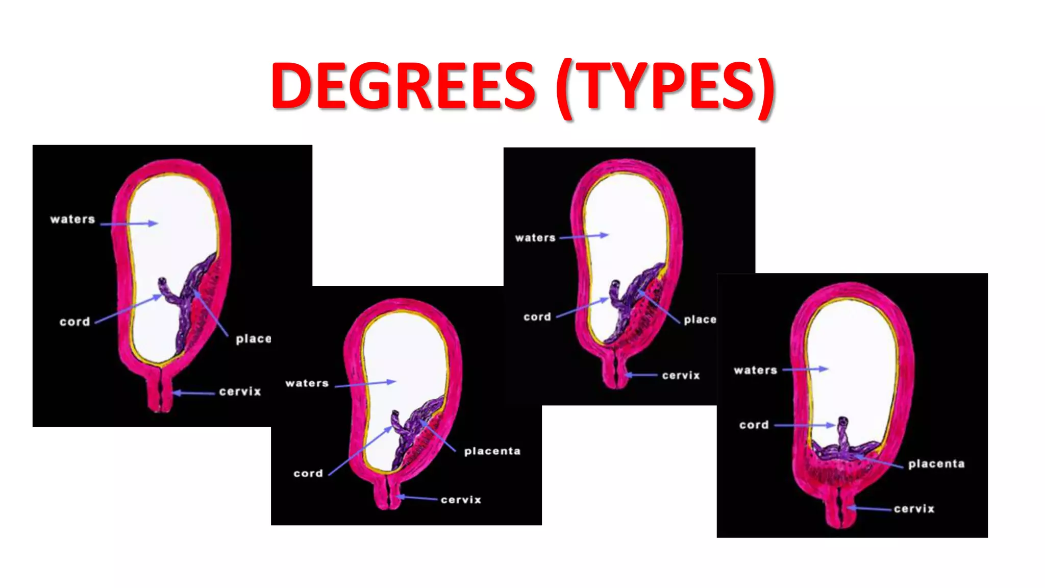 Placenta praevia | PPTX