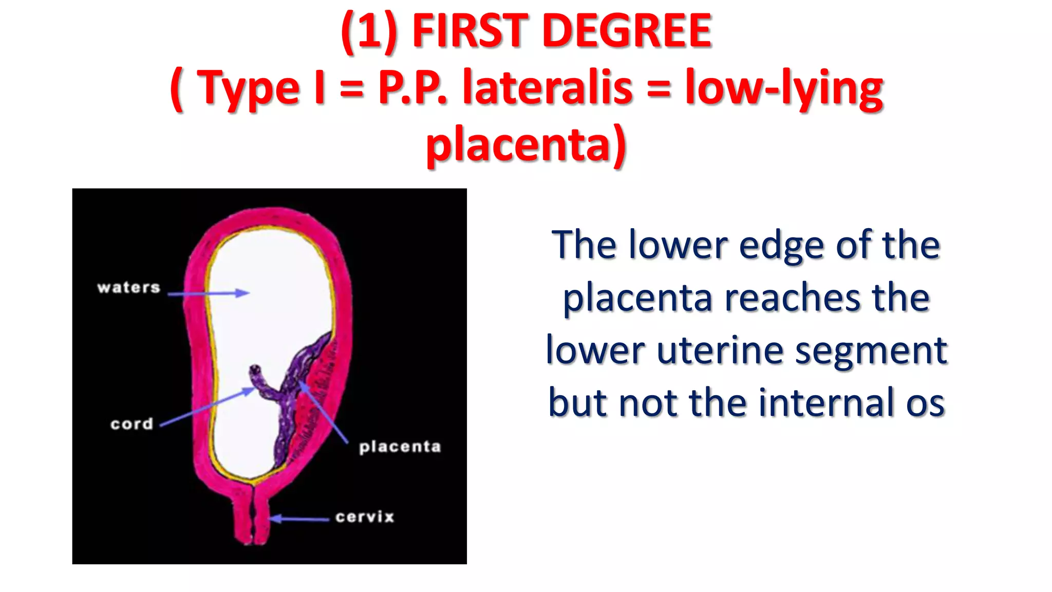 Placenta praevia | PPTX