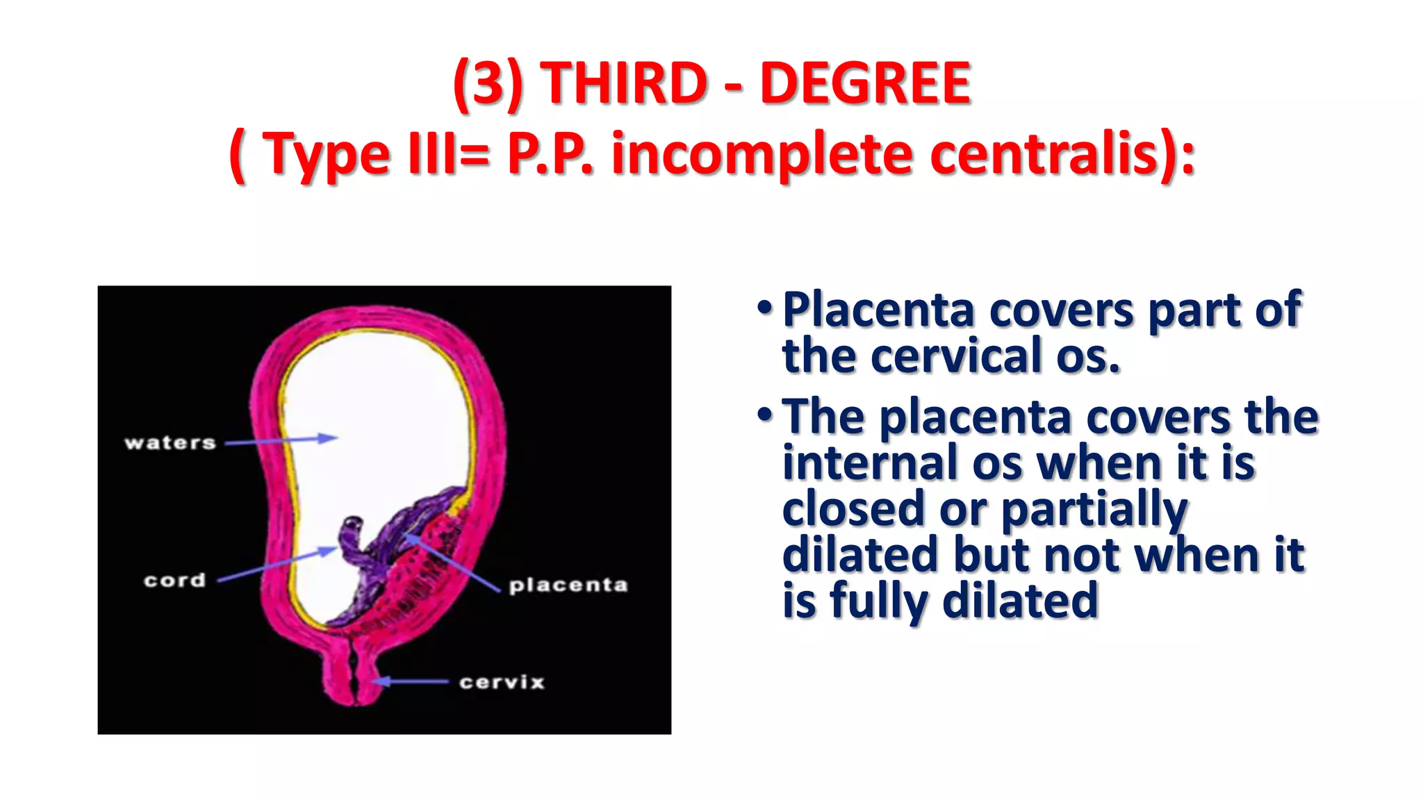 Placenta praevia | PPTX | Pregnancy | Reproductive Health