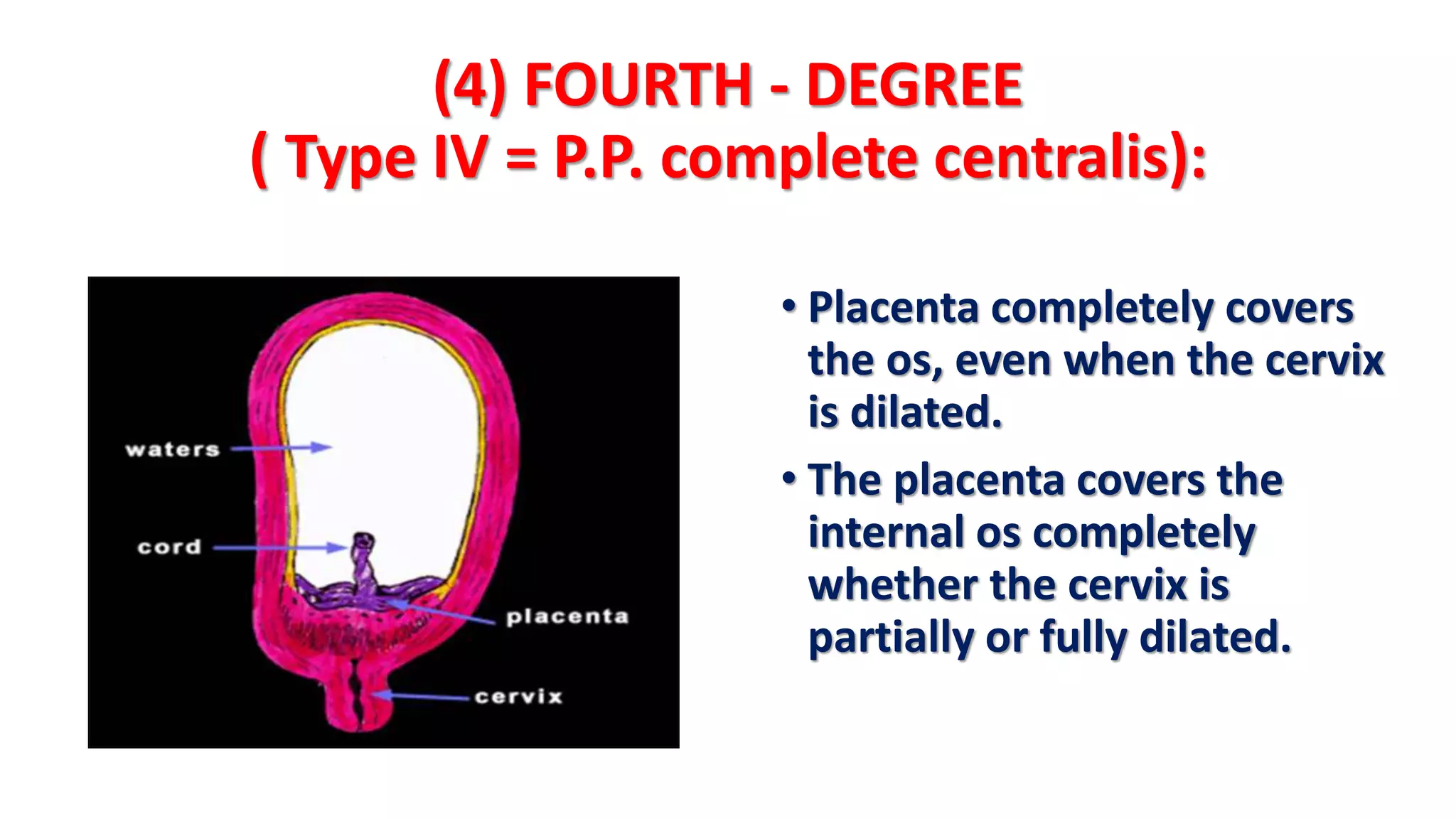 Placenta praevia | PPTX