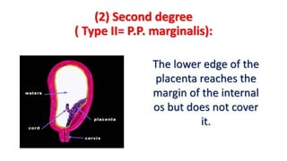 Placenta praevia | PPTX