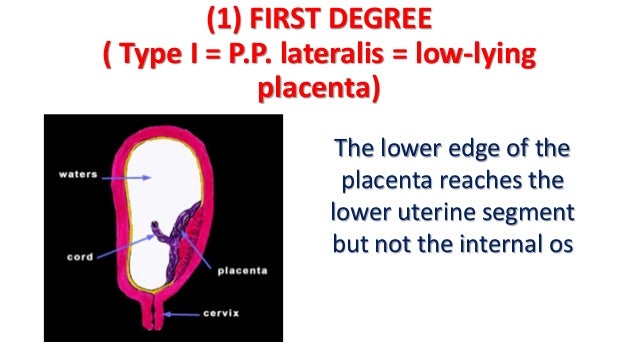 Placenta praevia