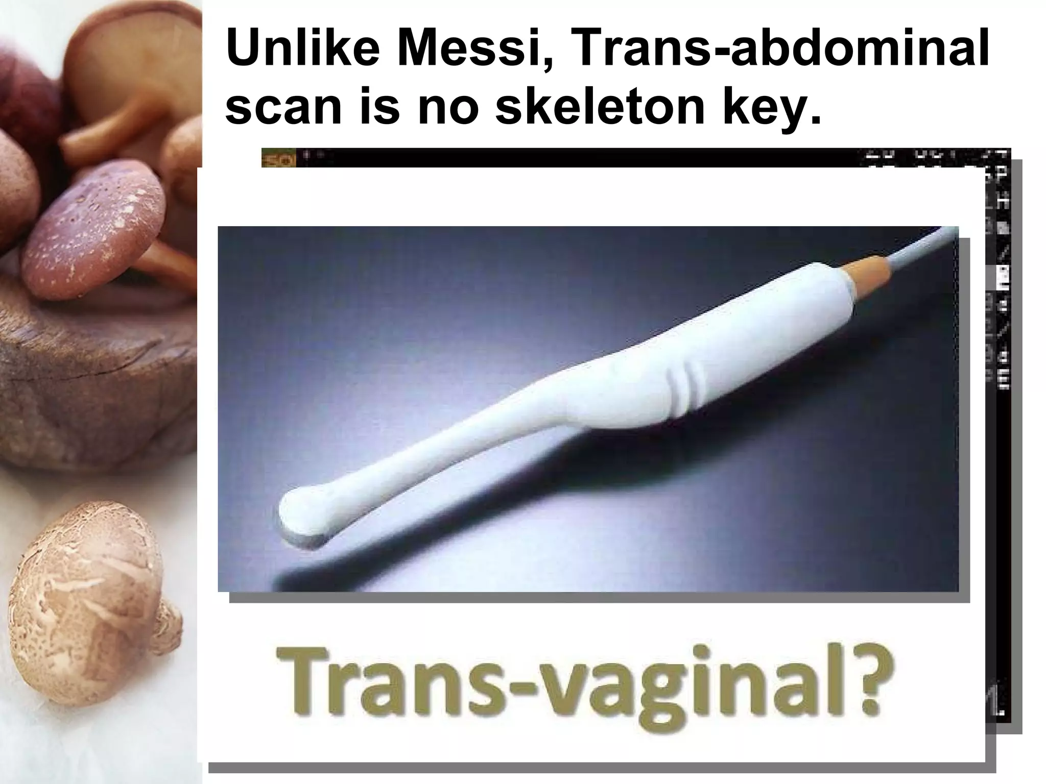 Placenta praevia: A brief overview | PPS | Pregnancy | Reproductive Health