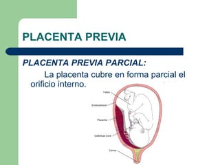 Placenta previa | PPT
