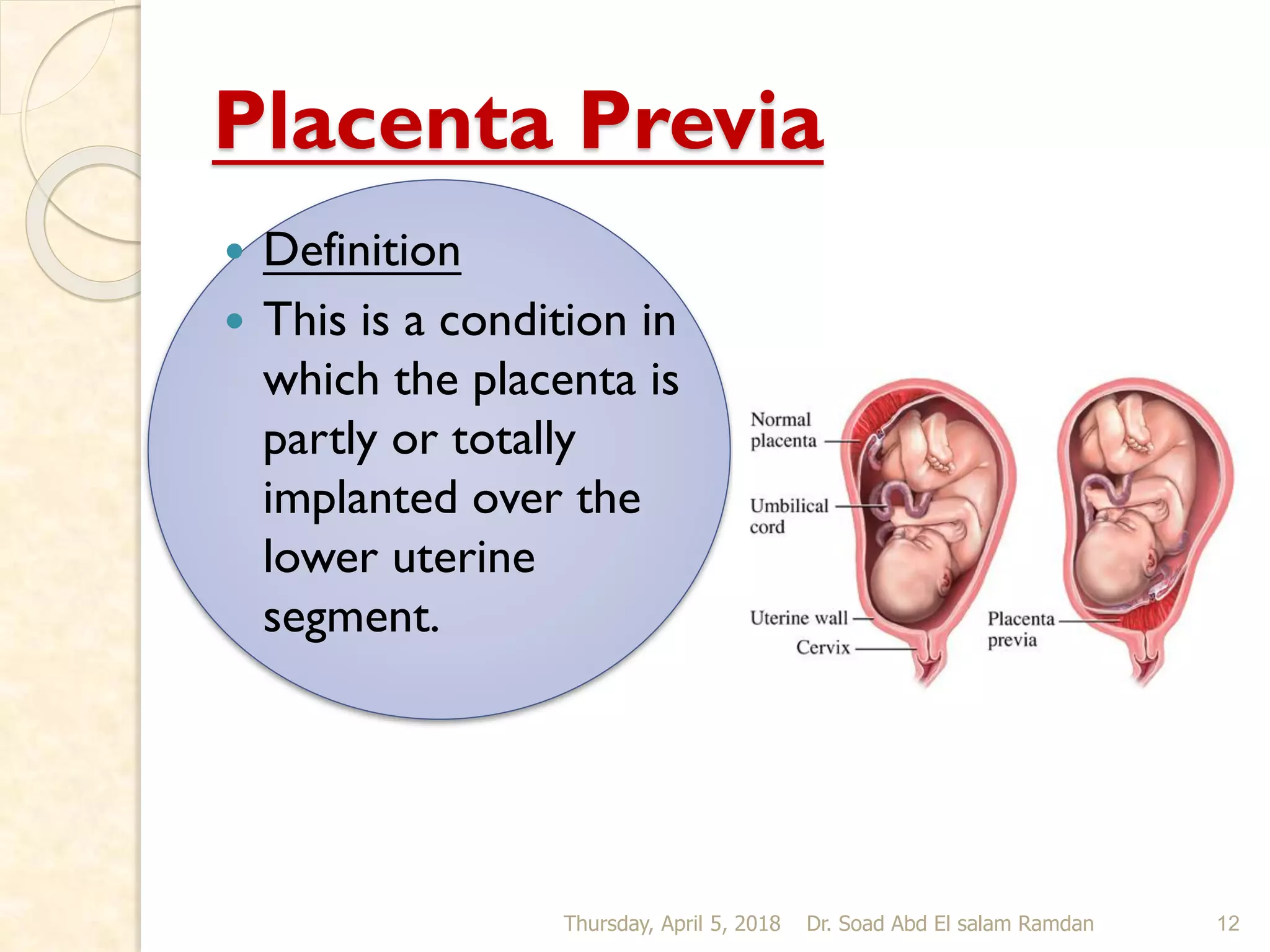 Placenta previa | PPT