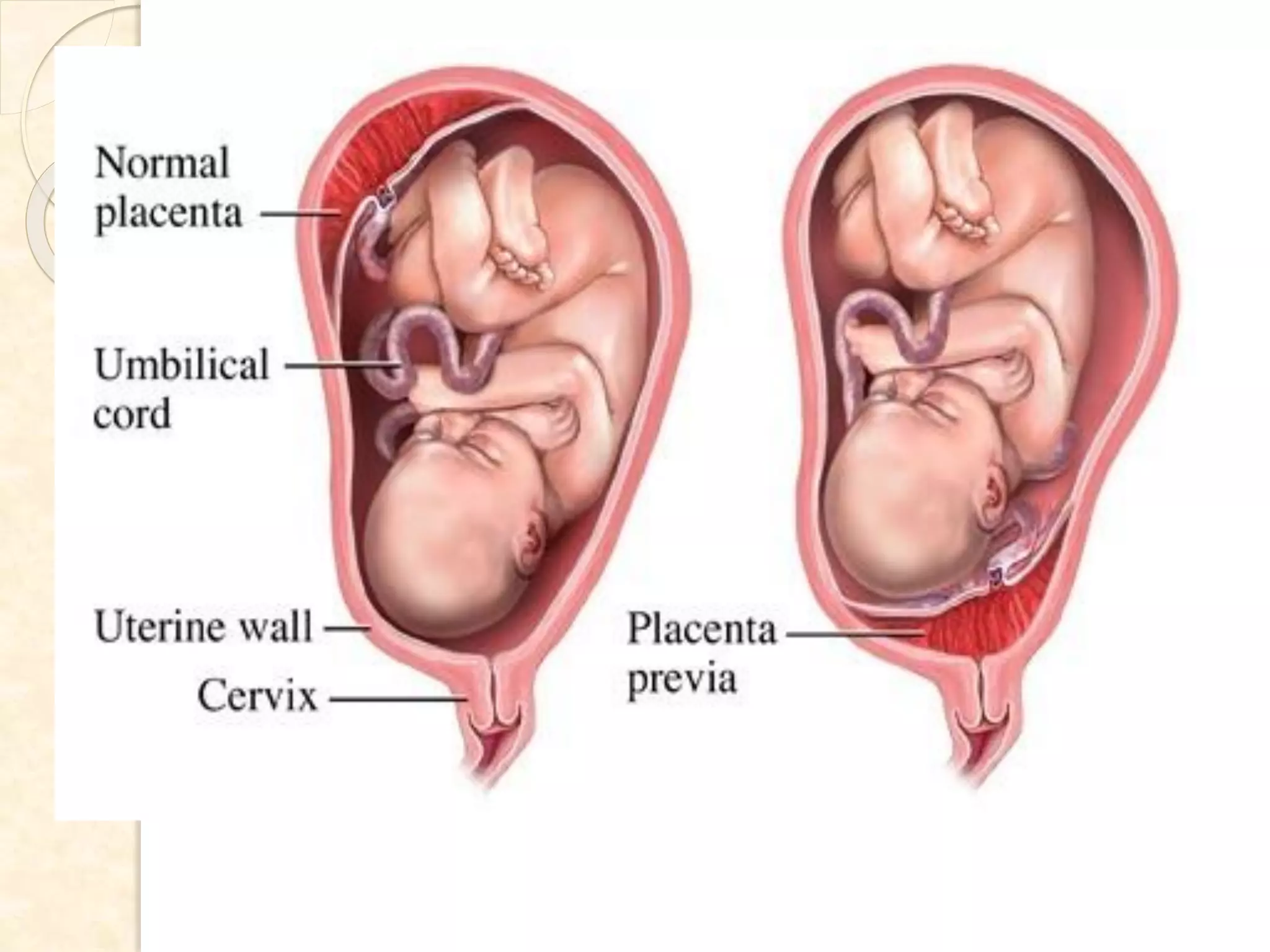 Placenta previa | PDF