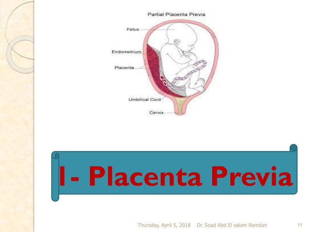 Placenta previa | PPT