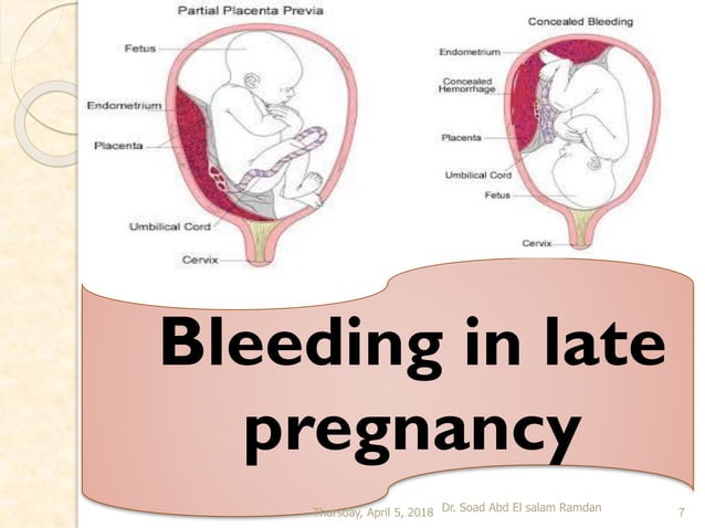 Placenta previa | PPT