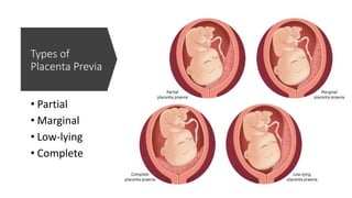 Placenta Previa | PPTX