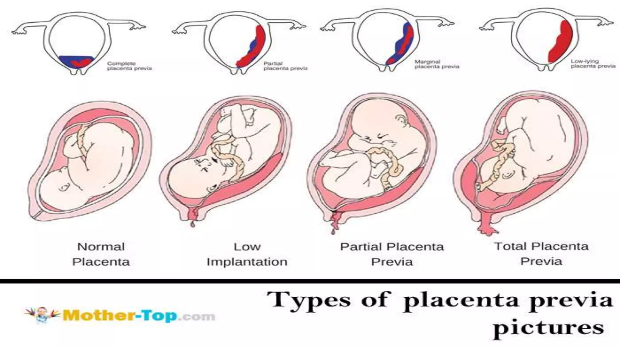 Placenta previa | PPTX