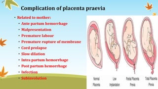 Placenta previa | PPTX