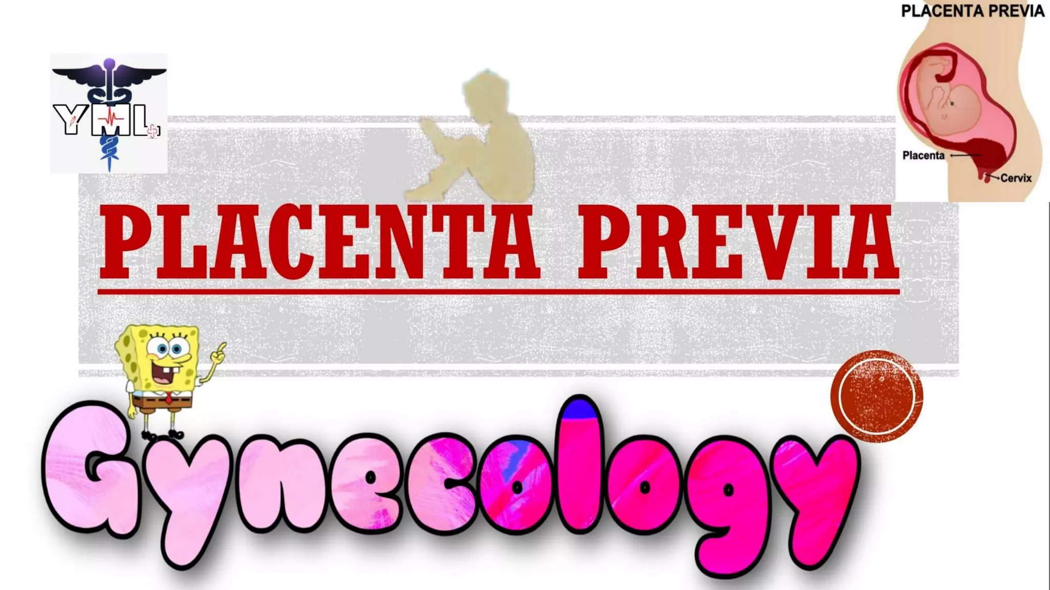 Placenta previa presentation by YML | PPTX
