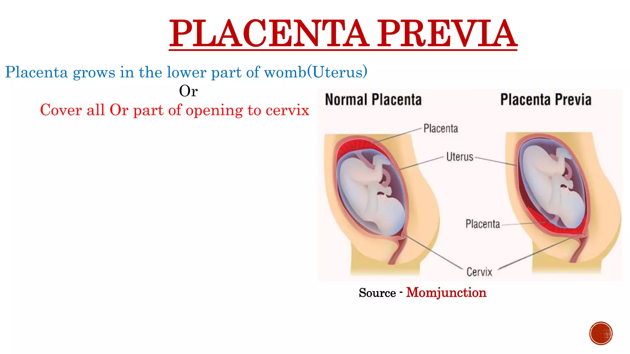 Placenta previa presentation by YML | PPTX