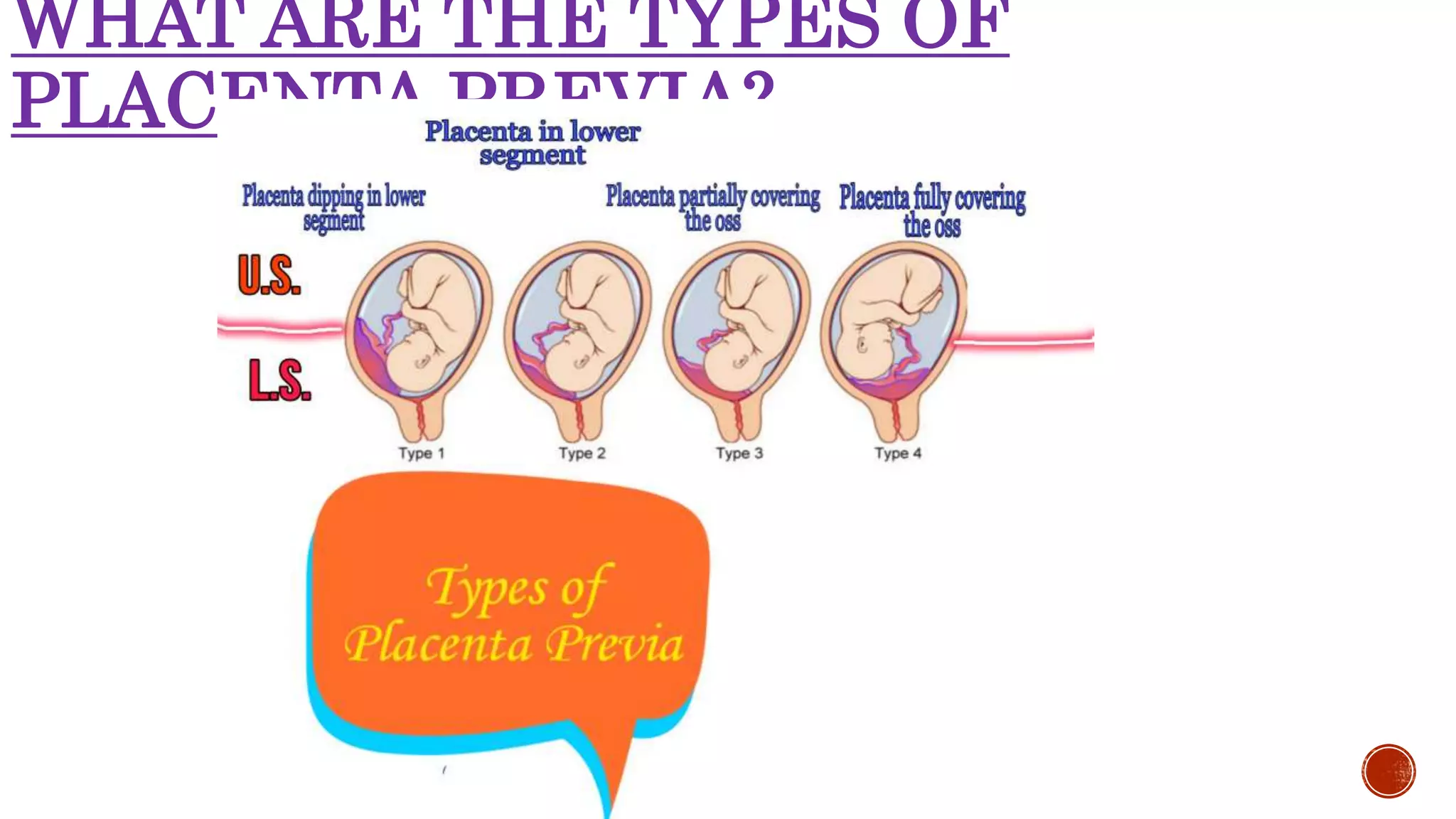 Placenta previa presentation by YML | PPTX