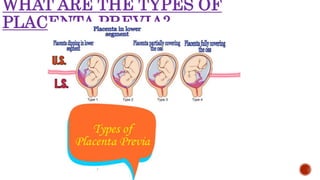 Placenta previa presentation by YML | PPTX