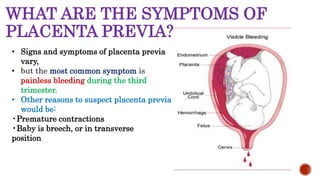 Placenta previa presentation by YML | PPTX