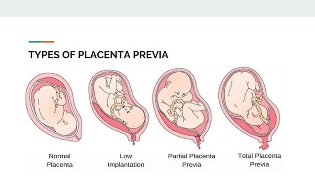 placenta previa.pptx