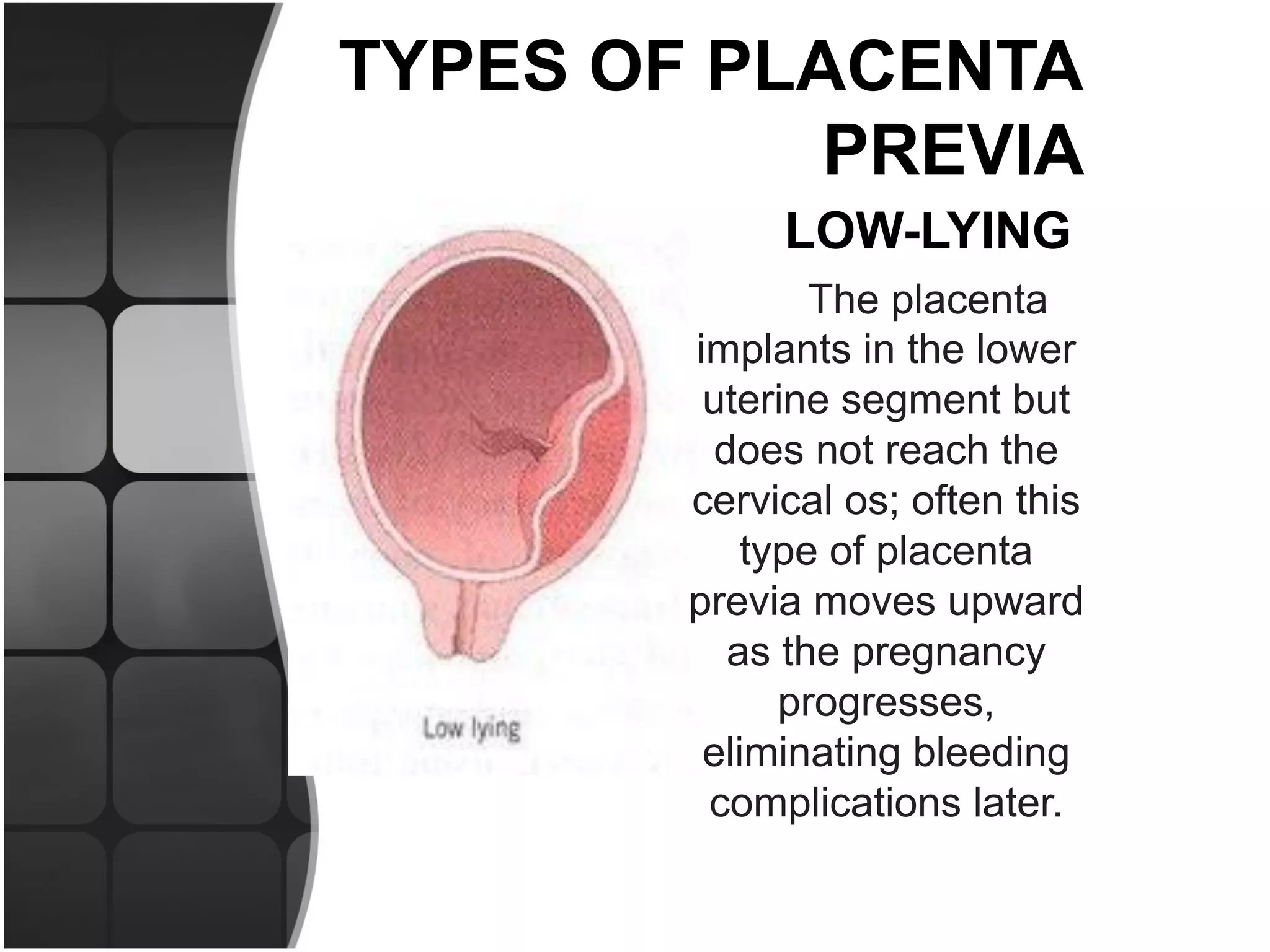PLACENTA PREVIA.ppt.pdf