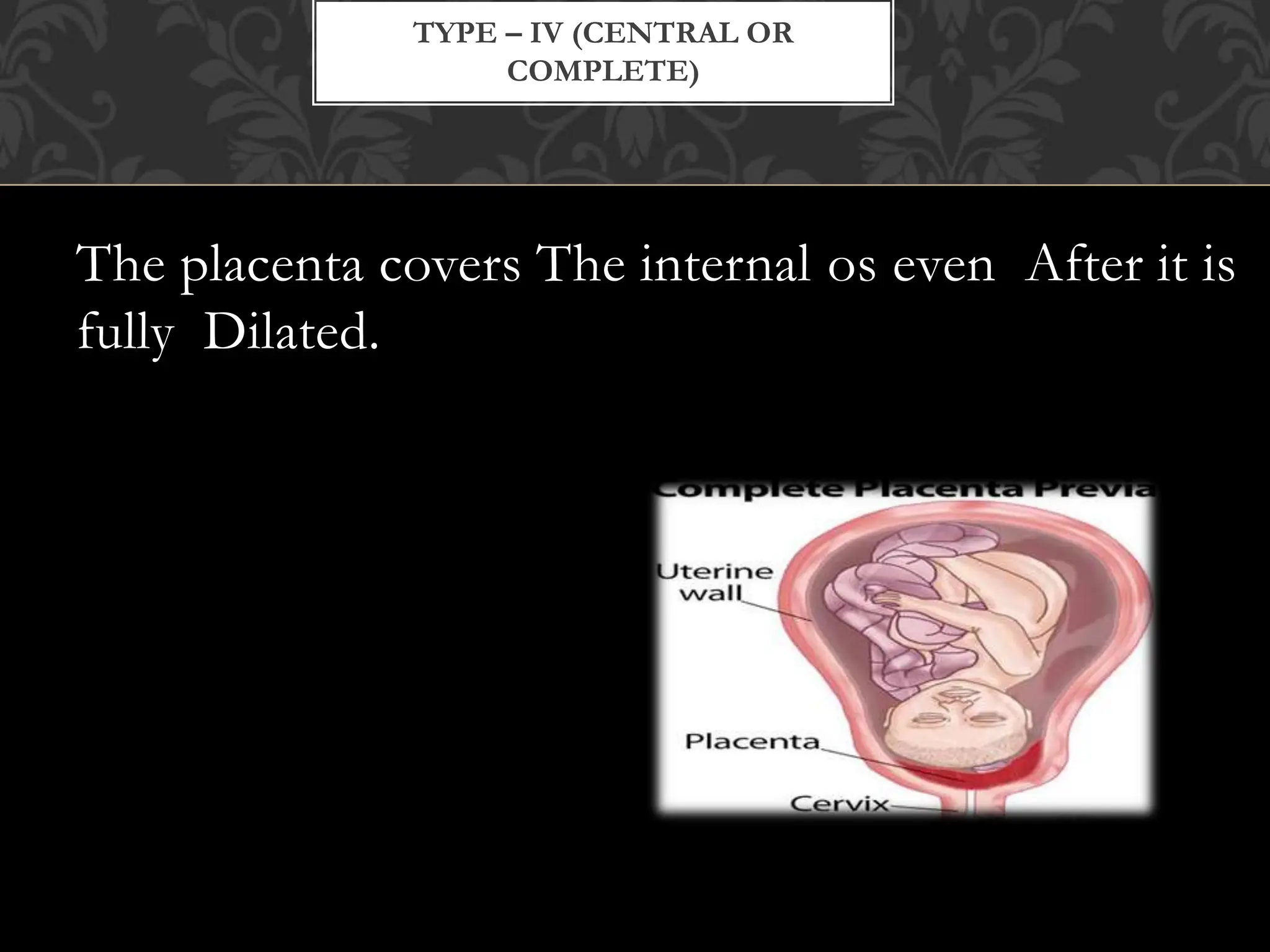 PLACENTA PREVIA. a disorder of Pregnancy | PPTX