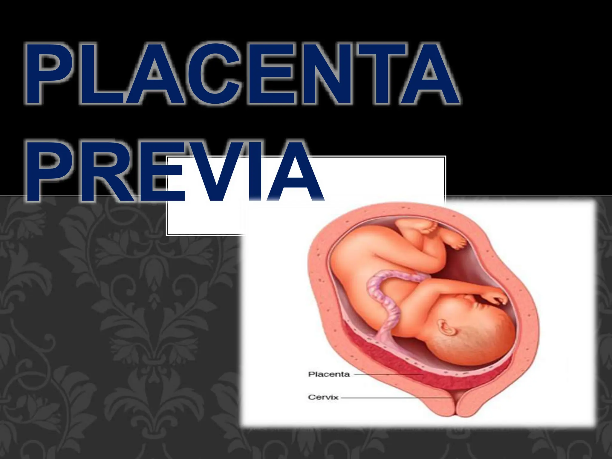 PLACENTA PREVIA. a disorder of Pregnancy | PPTX