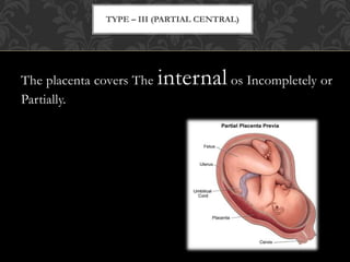 PLACENTA PREVIA. a disorder of Pregnancy | PPTX