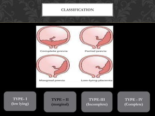 PLACENTA PREVIA. a disorder of Pregnancy | PPTX