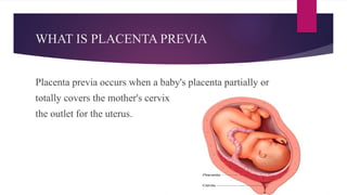 Placenta Previa.pptx /gynaecology/ obstetric nursing | PPT