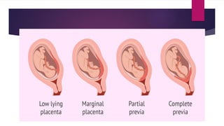 Placenta Previa.pptx /gynaecology/ obstetric nursing | PPT