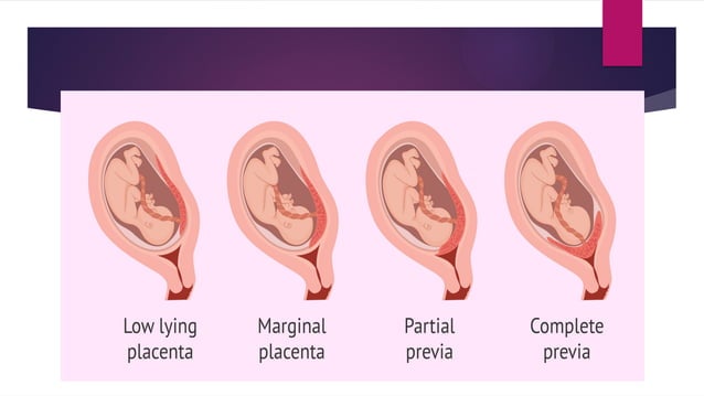 Placenta Previa.pptx /gynaecology/ obstetric nursing | PPT