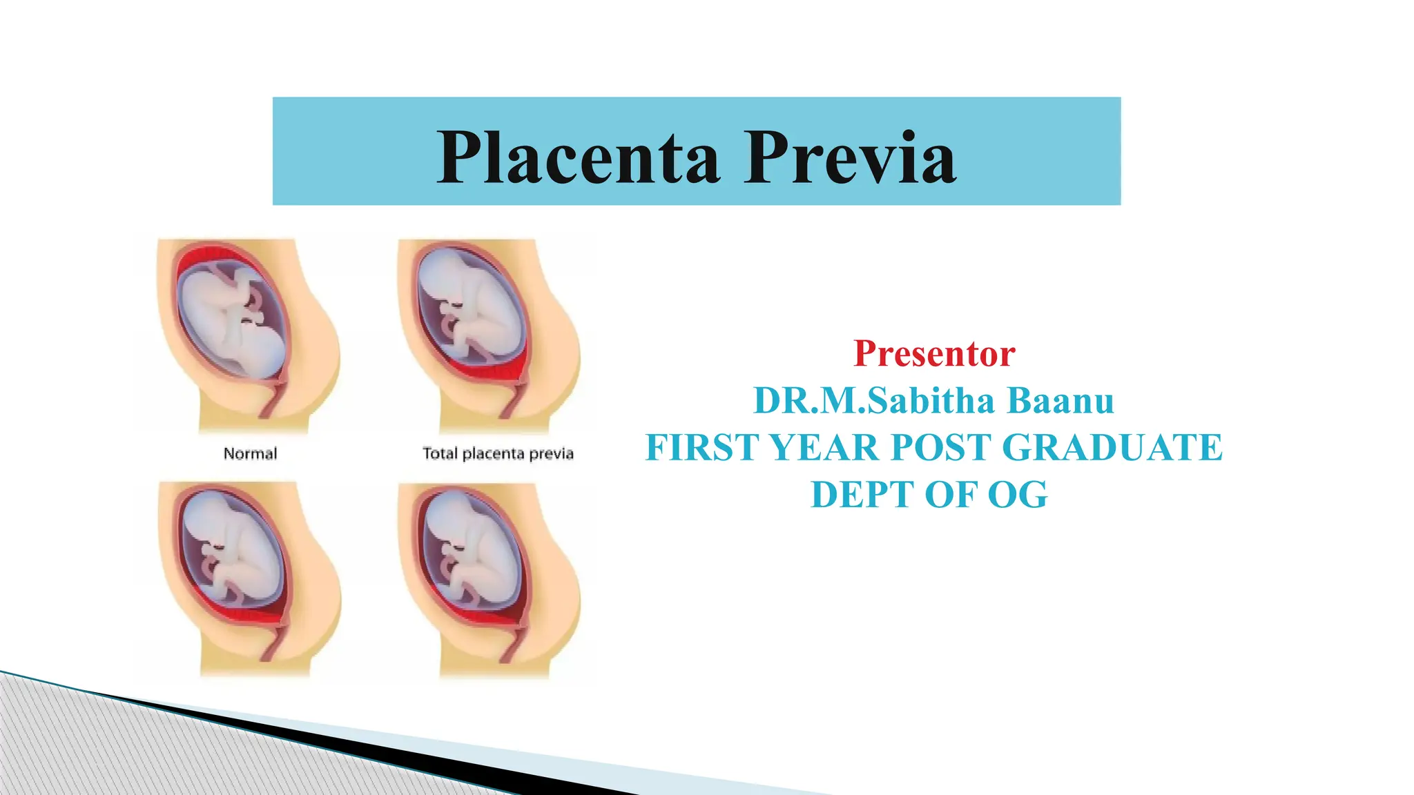 PLACENTA PREVIA -Antepartum hemorrhage.pptx