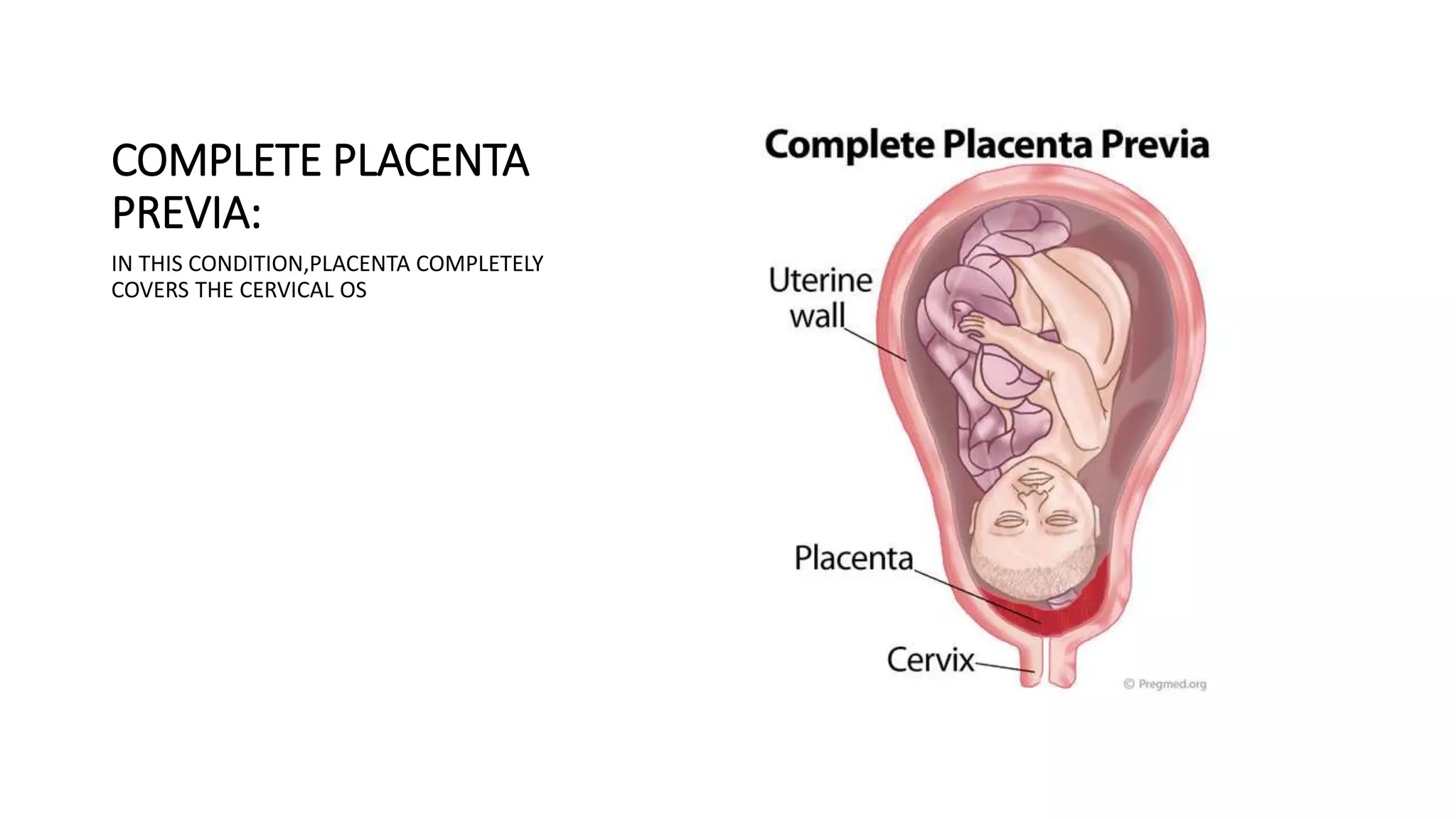 Placenta previa and discharge of patients after c section | PPTX