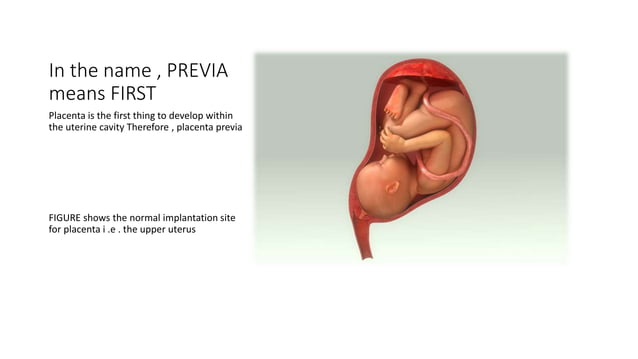 Placenta previa and discharge of patients after c section | PPT