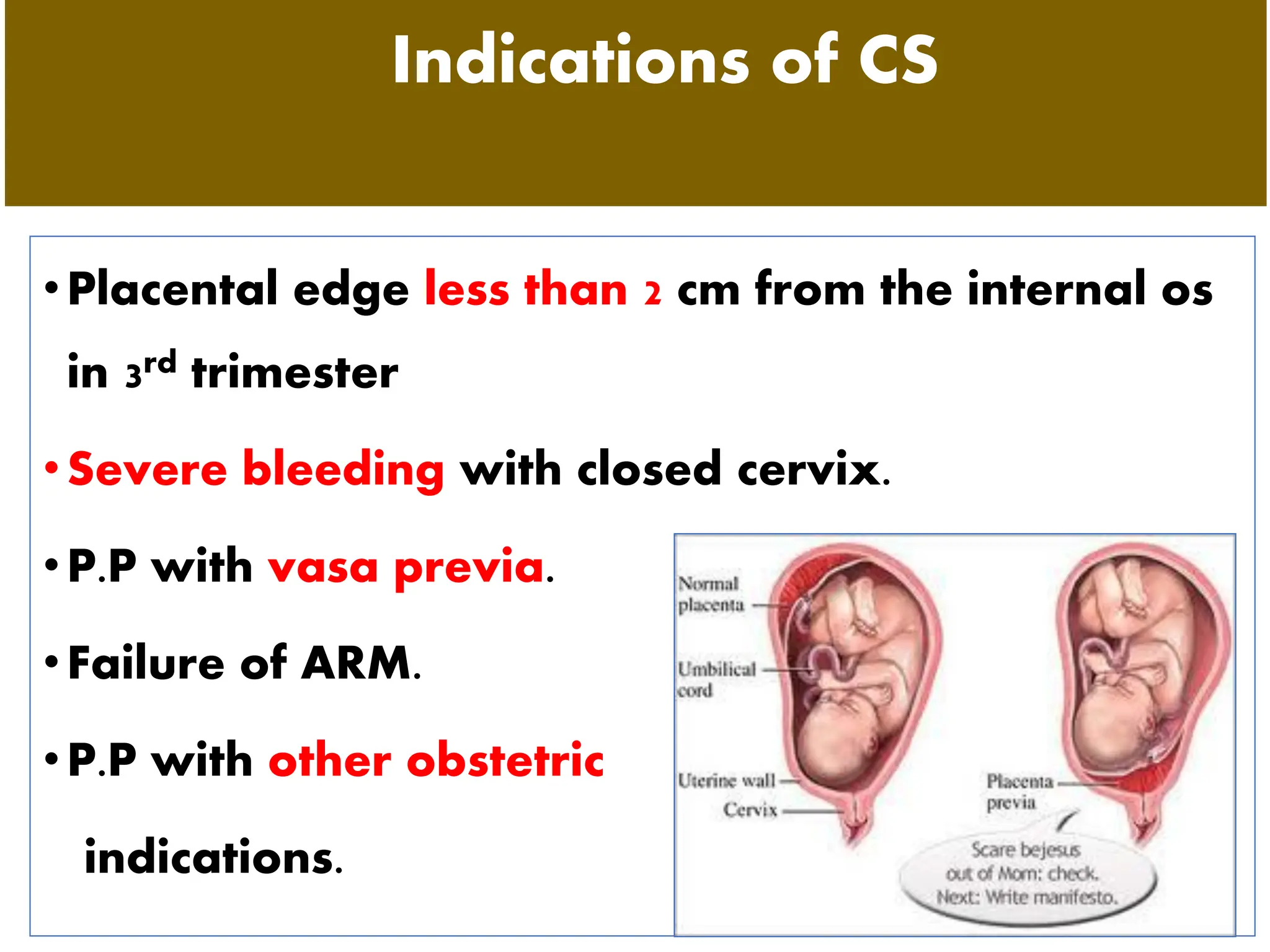 placenta Previa (APHge).pdf
