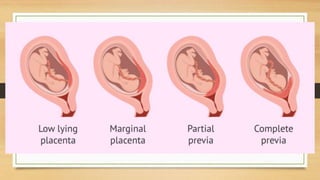 placenta previa mine.pptx