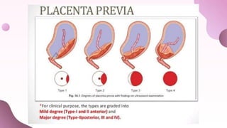 Placenta Previa Partial Clinical Case by Slidesgo.ppt