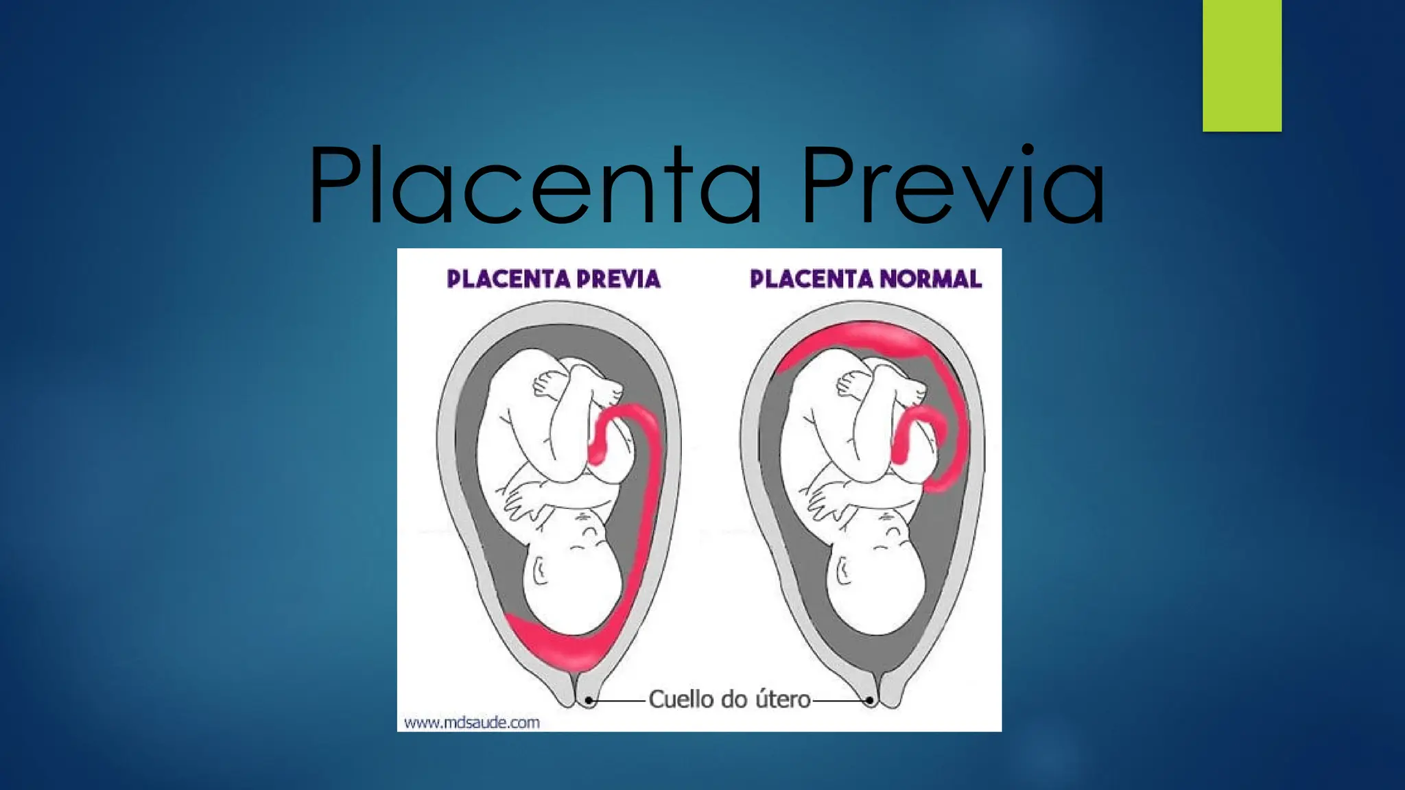 Placenta previa Placenta acreta placenta normo inserta | PPTX