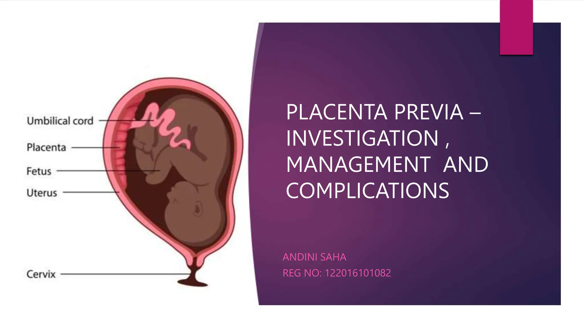 PLACENTA PREVIA REMASTERED Presentation[1].pptx