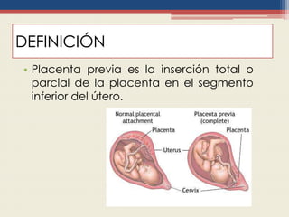 Placenta previa, vasa previa | PPTX