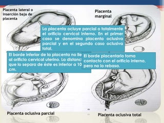 Placenta previa, vasa previa | PPTX