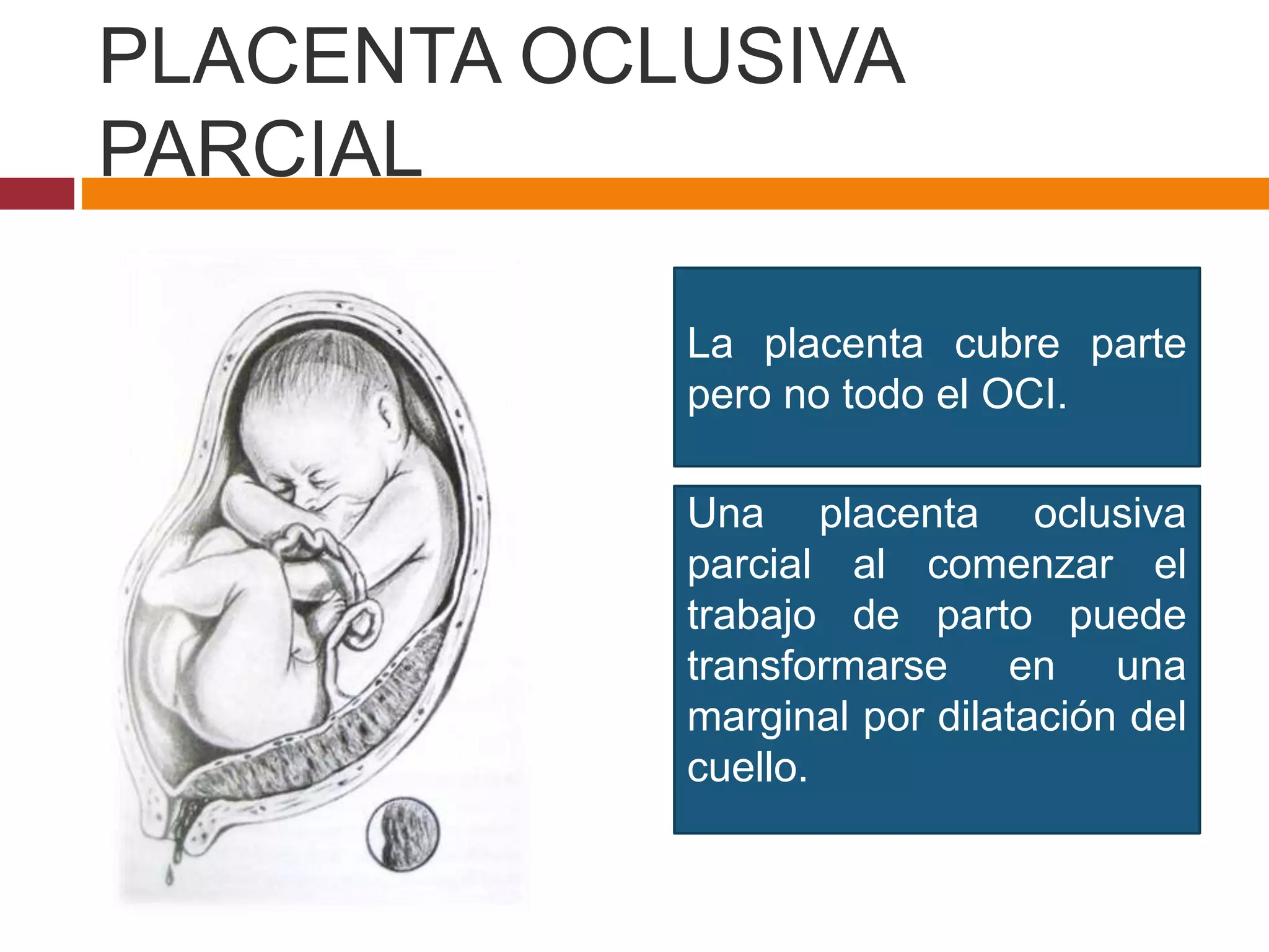 Placenta Previa - Cerclaje Cervical | PPTX