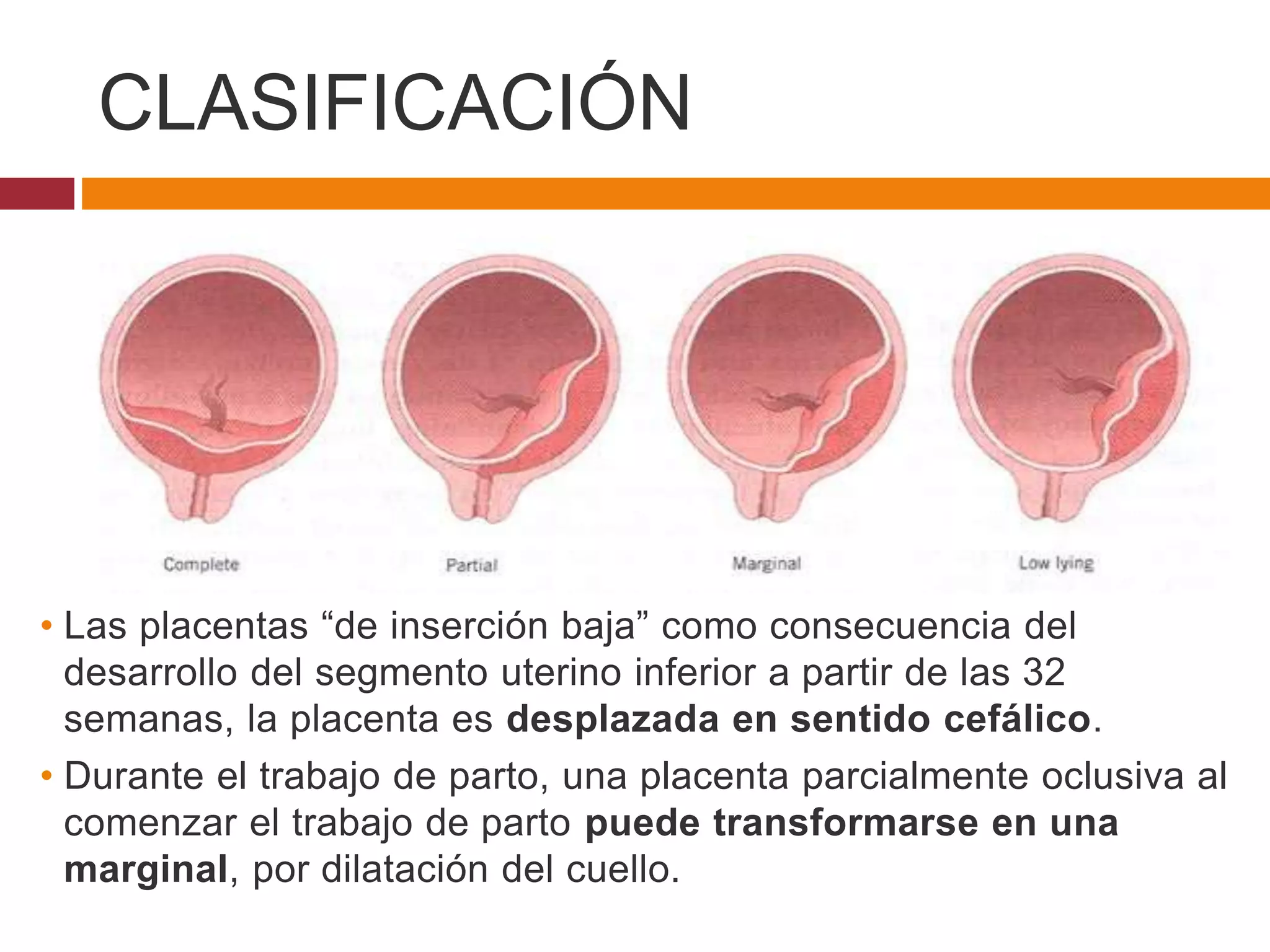 Placenta Previa - Cerclaje Cervical | PPTX