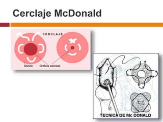 Placenta Previa - Cerclaje Cervical | PPTX