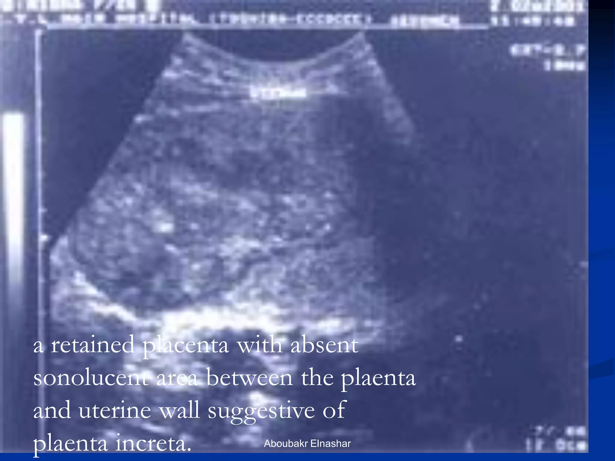 Retained placenta | PDF