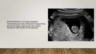 Placenta types and grading | PPTX