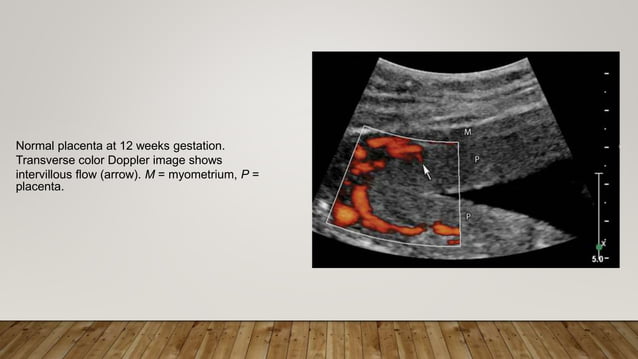 Placenta types and grading | PPTX | Pregnancy | Reproductive Health
